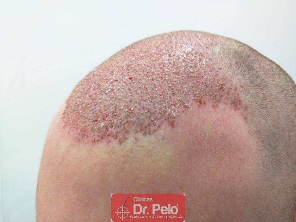 Injerto capilar con la técnica FUE, frontal y coronilla | Clínicas Dr. Pelo