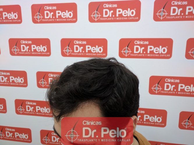 tratamiento capilar dr pelo_12 | Clínicas Dr. Pelo